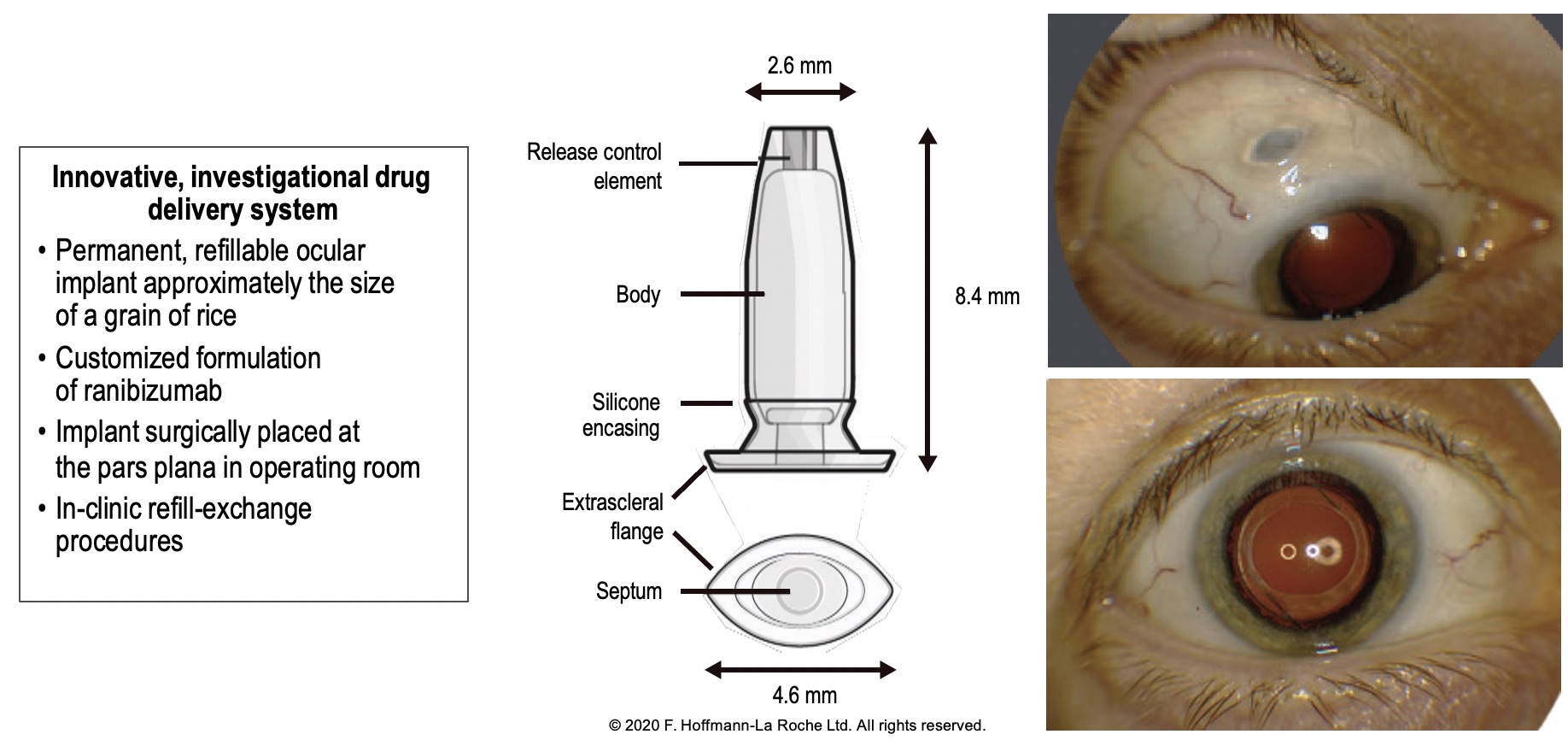 The Port Delivery System with Ranibizumab (PDS): Analytical.... AAPS ...