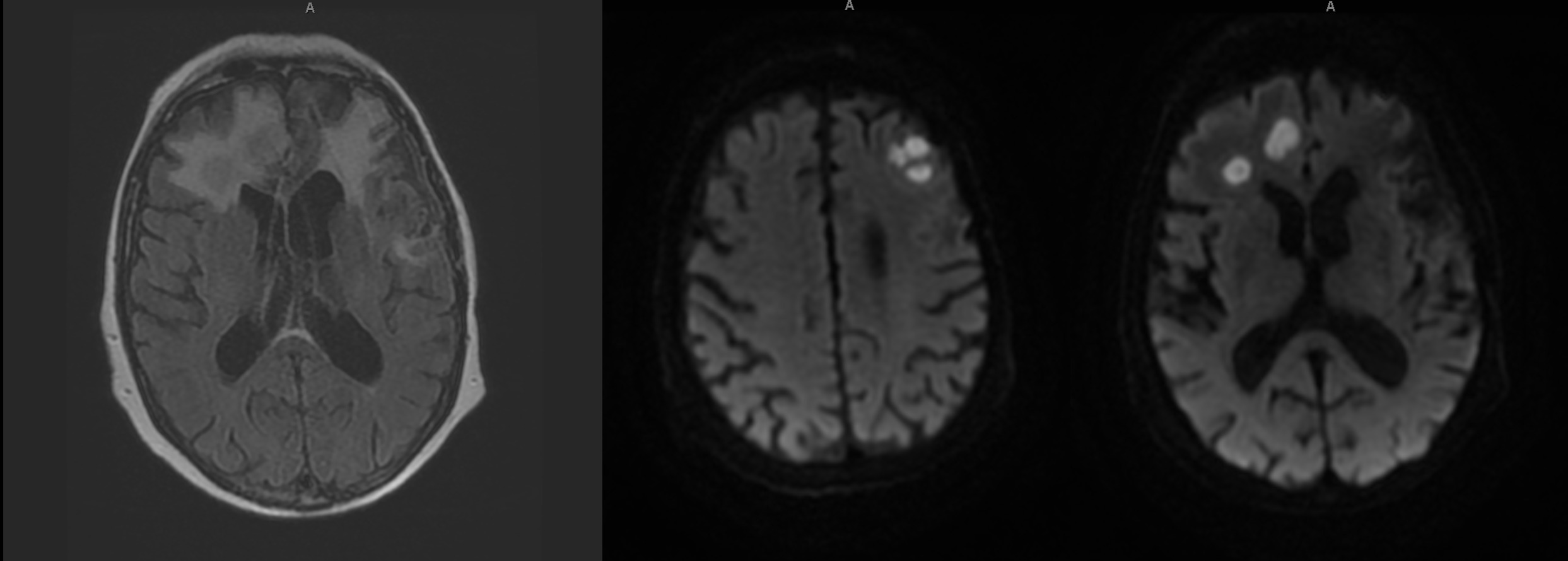 DISSEMINATED NOCARDIA FARCINICA PRESENTING AS AN ABDOMINAL WALL ABSCESS ...