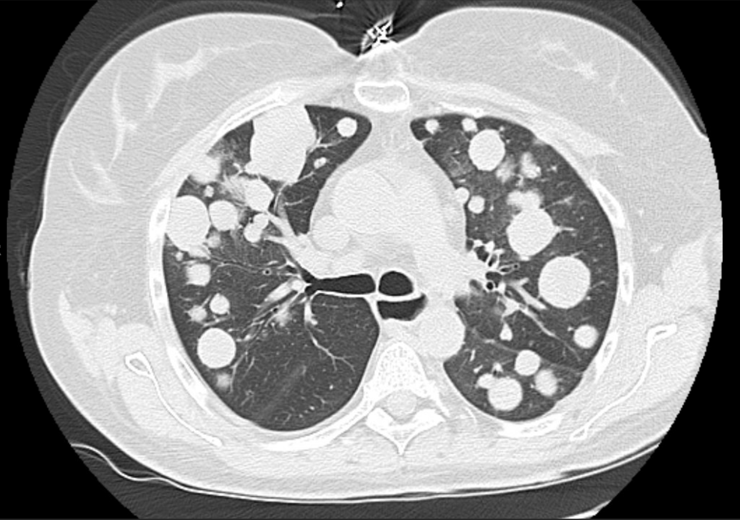 CANNONBALL: A RARE TRANSFORMATION OF ALK-NEGATIVE PRIMARY CUTANEOUS ...